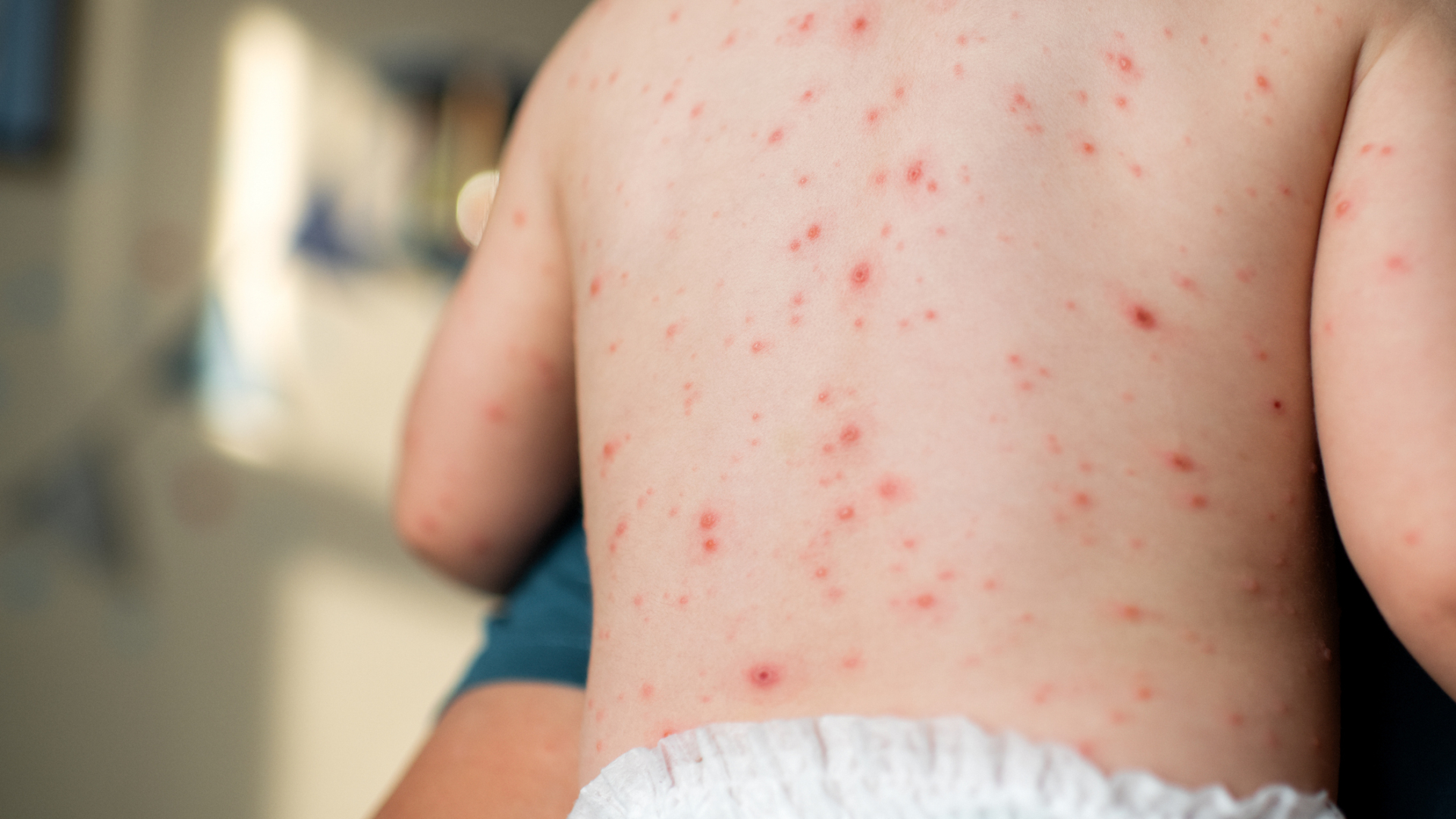 Vattkoppor, varicellae | Praktisk Medicin