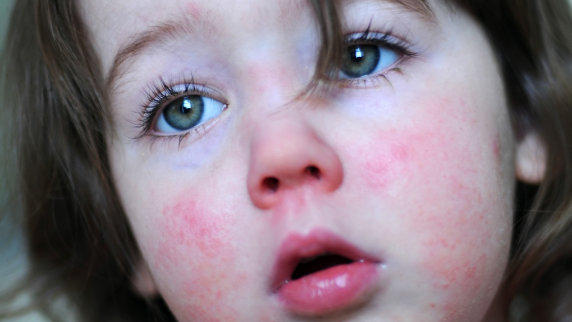 Scharlakansfeber, scarlatina | Praktisk Medicin