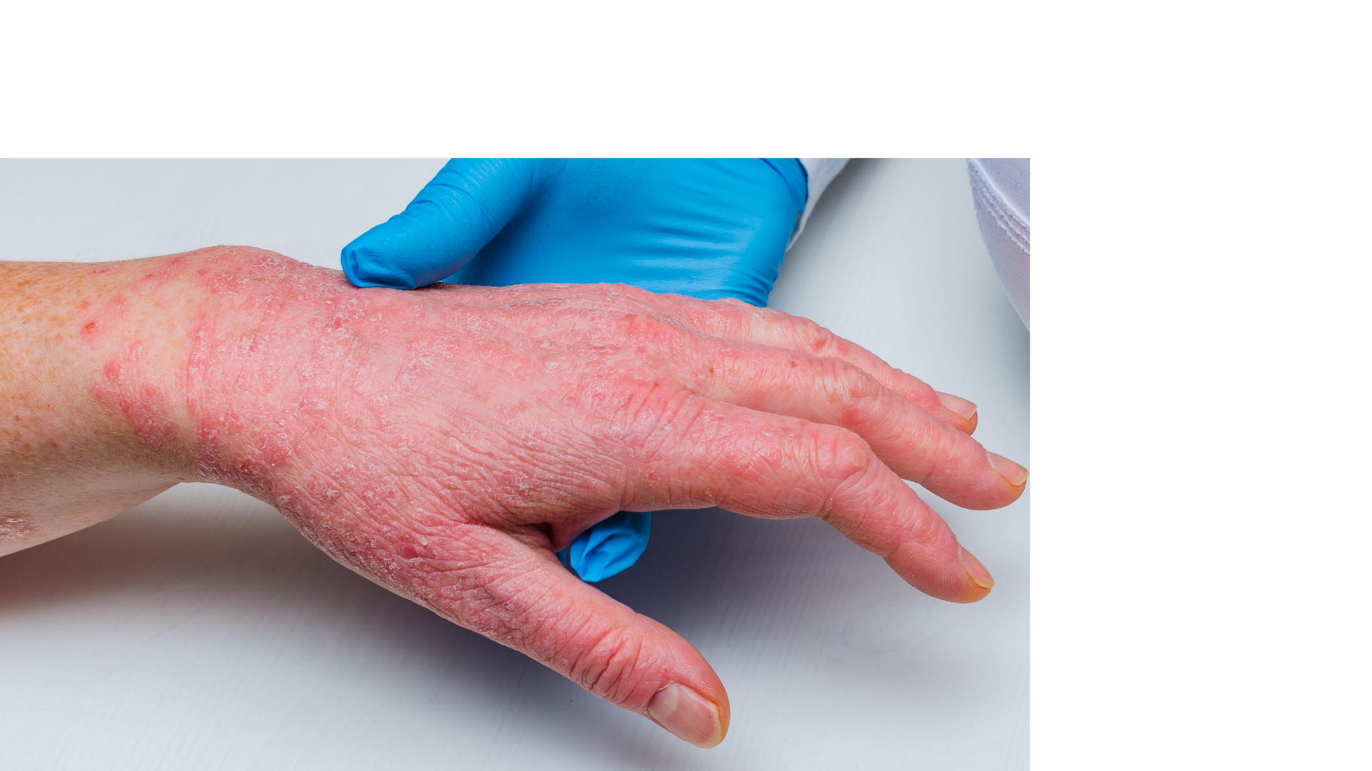 Eksem: Allergisk kontaktdermatit, allergiskt handeksem