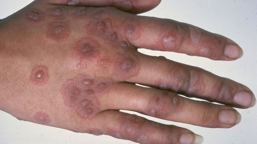 Erythema multiforme | Praktisk Medicin