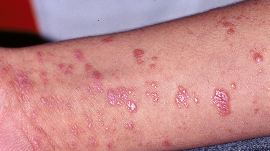 Lichen ruber planus | Praktisk Medicin