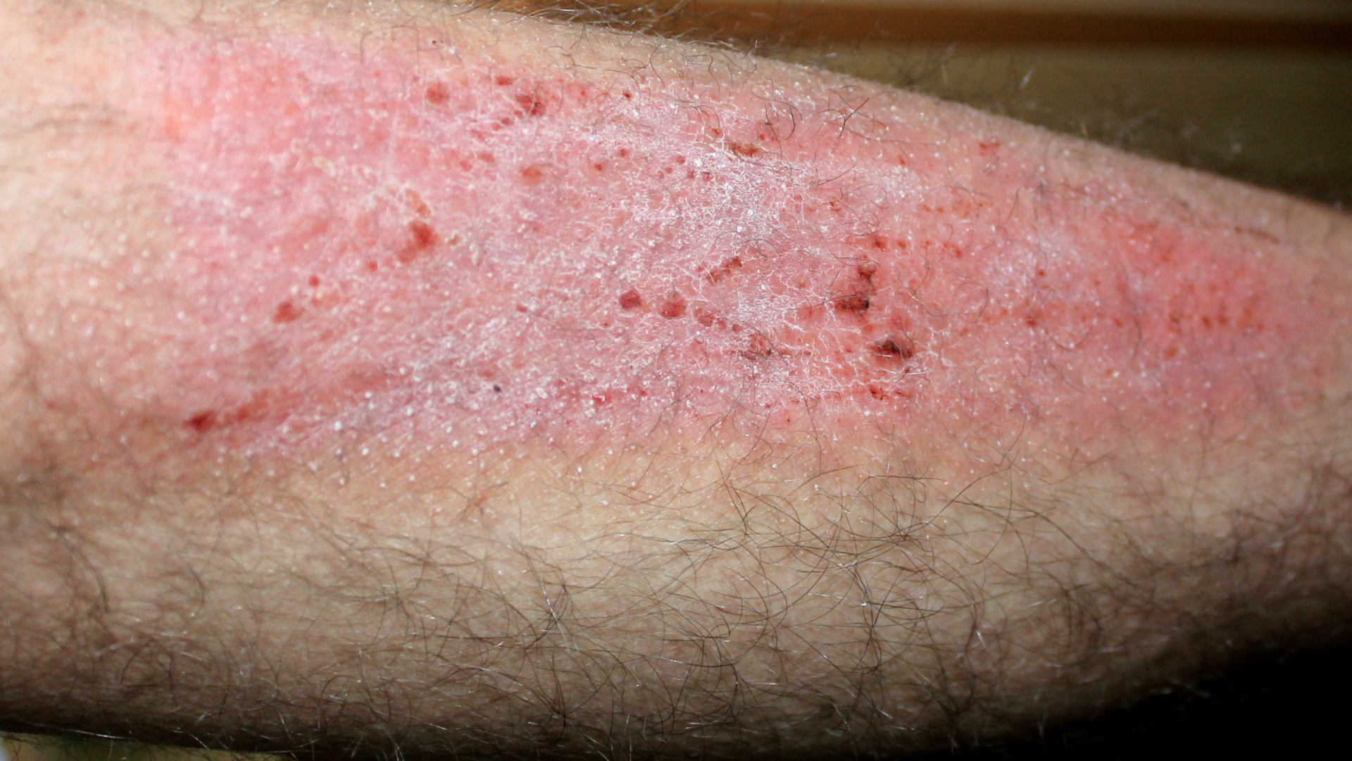 Neurodermit, lichen simplex | Praktisk Medicin