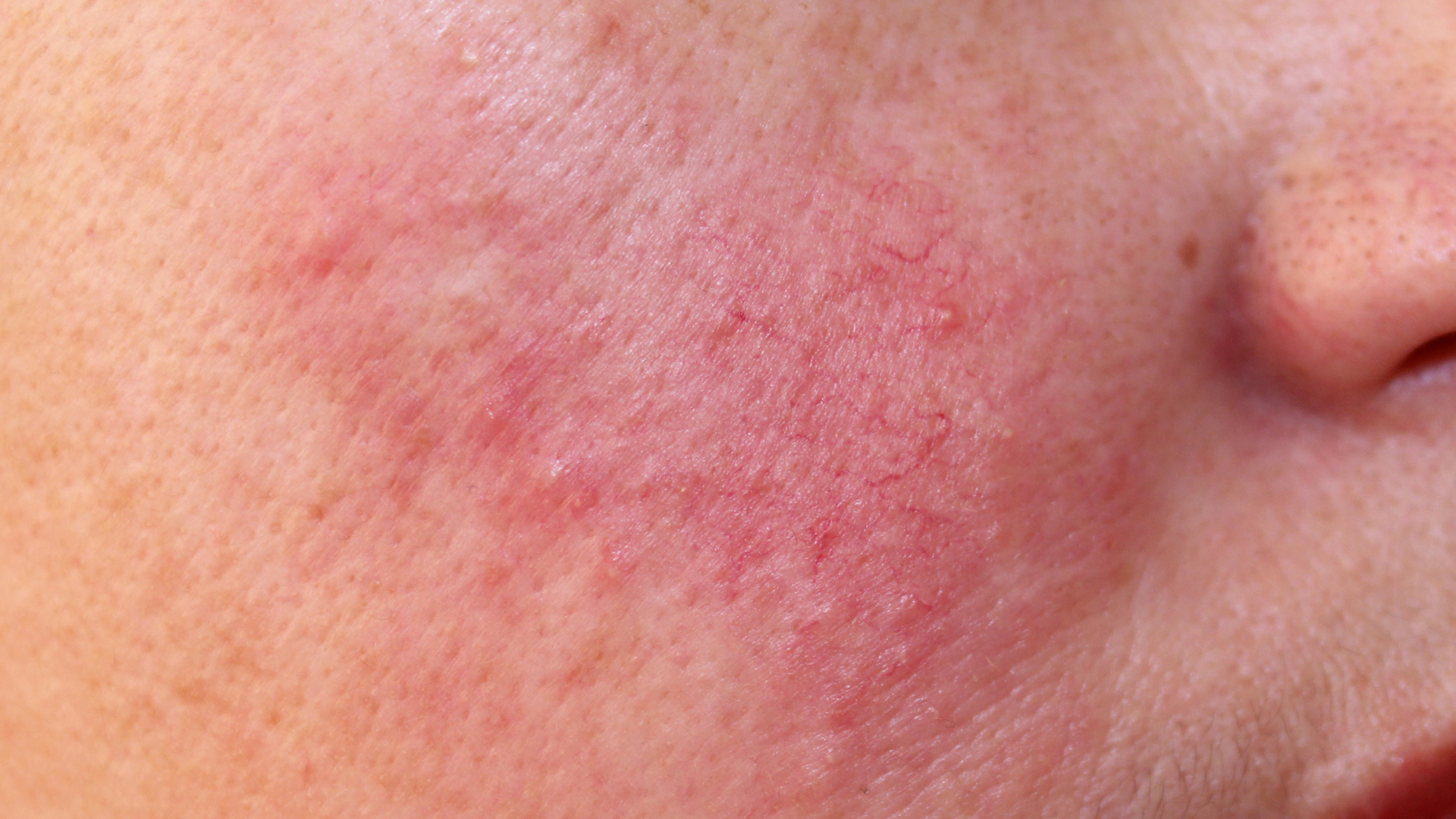 Rosacea | Praktisk Medicin