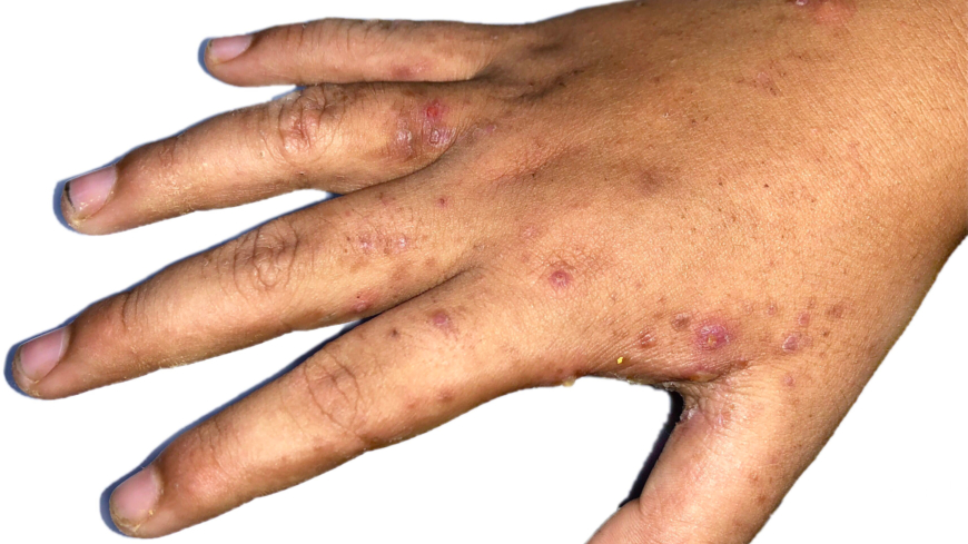 Scabies, skabb | Praktisk Medicin