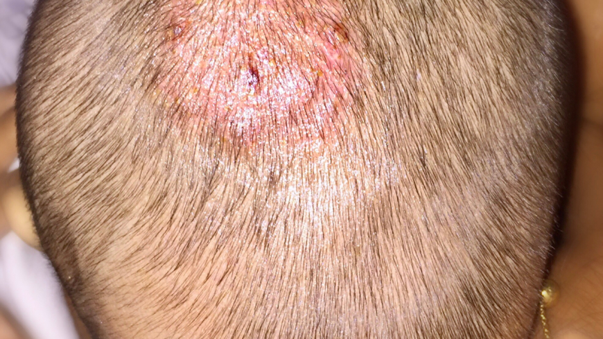 Tinea capitis, svamp i hårbotten | Praktisk Medicin
