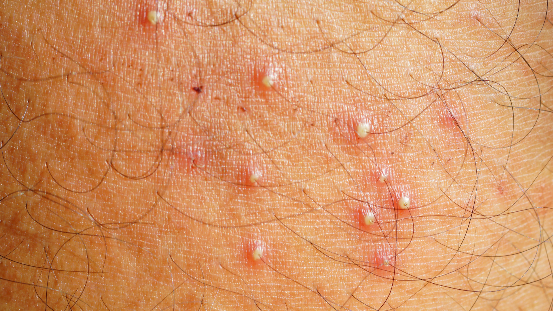 Follikulit | Praktisk Medicin