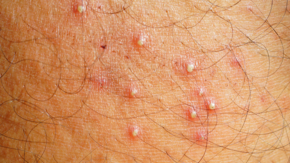 Follikulit | Praktisk Medicin