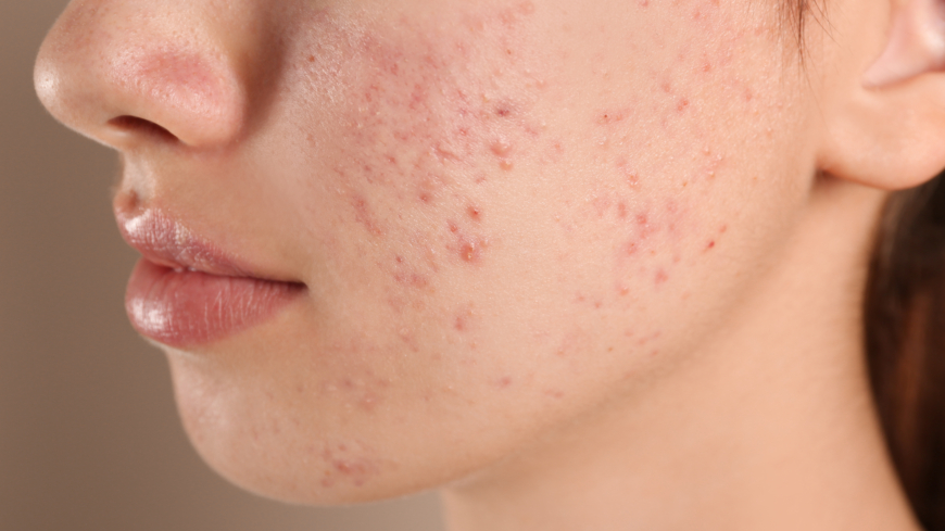 Akne (acne vulgaris, acne tarda) | Praktisk Medicin