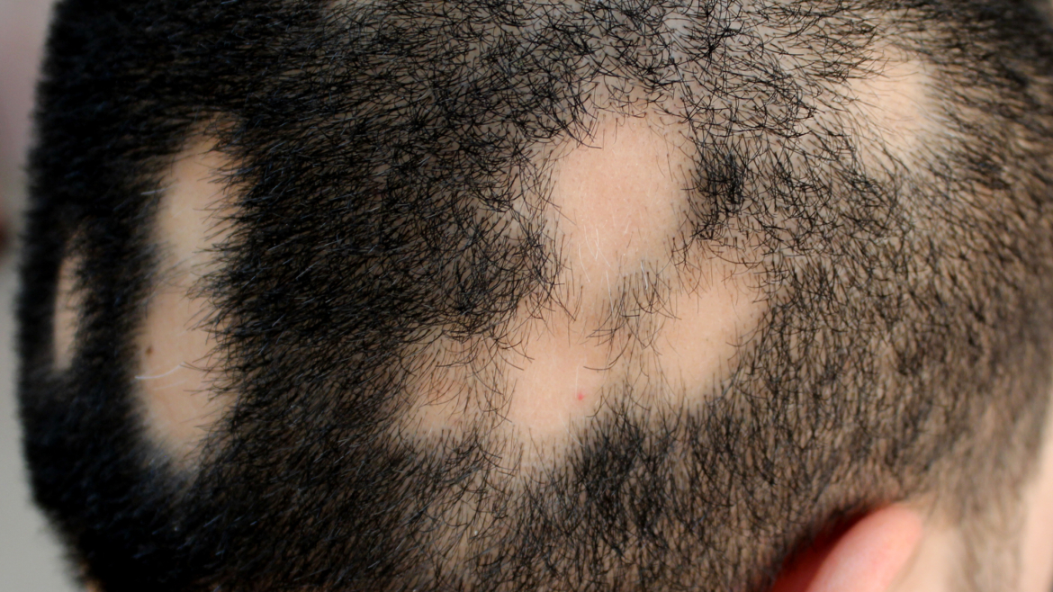 Håravfall: Alopecia areata | Praktisk Medicin