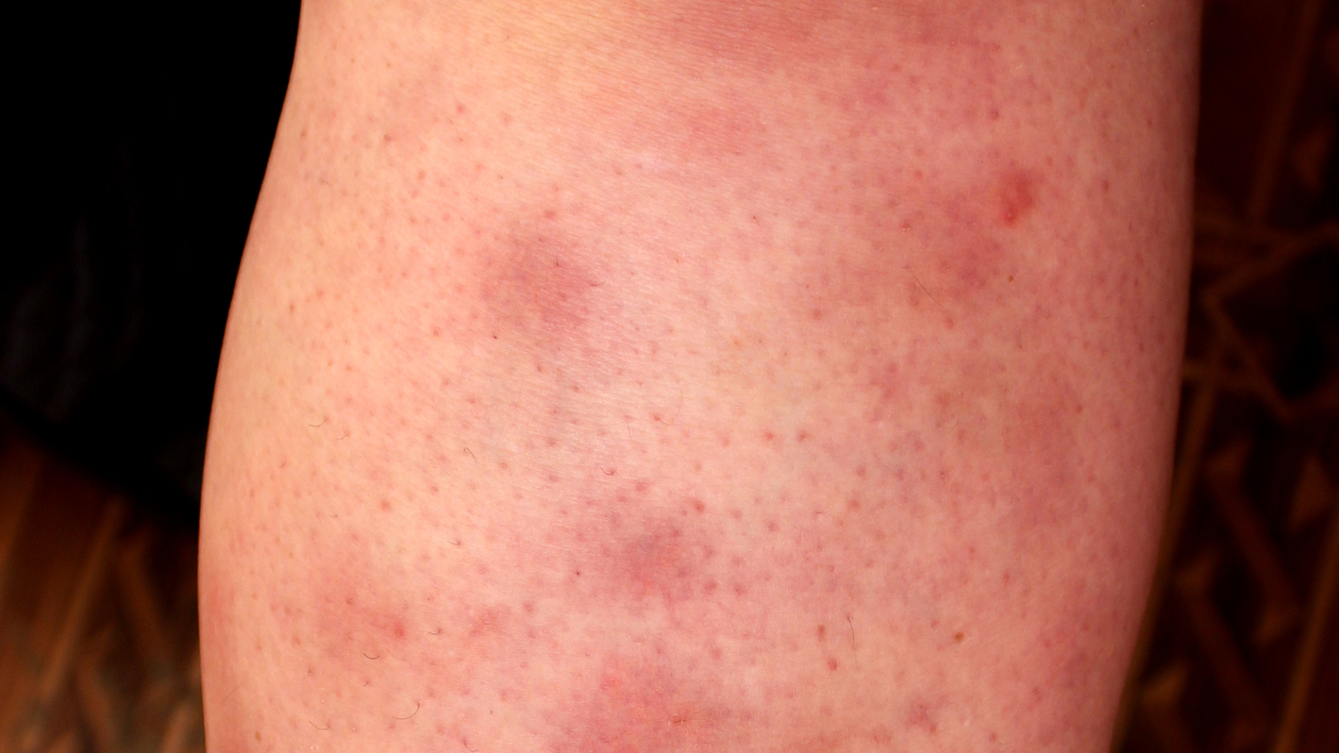 Erythema nodosum, knölros | Praktisk Medicin