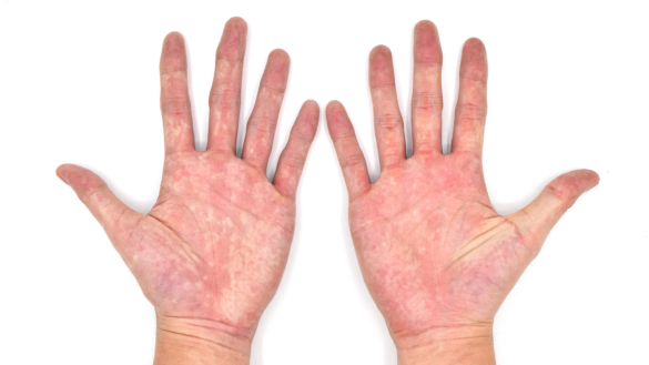 Palmarerythem | Praktisk Medicin