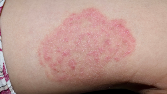 Svampinfektioner i huden: Tinea corporis, ringorm