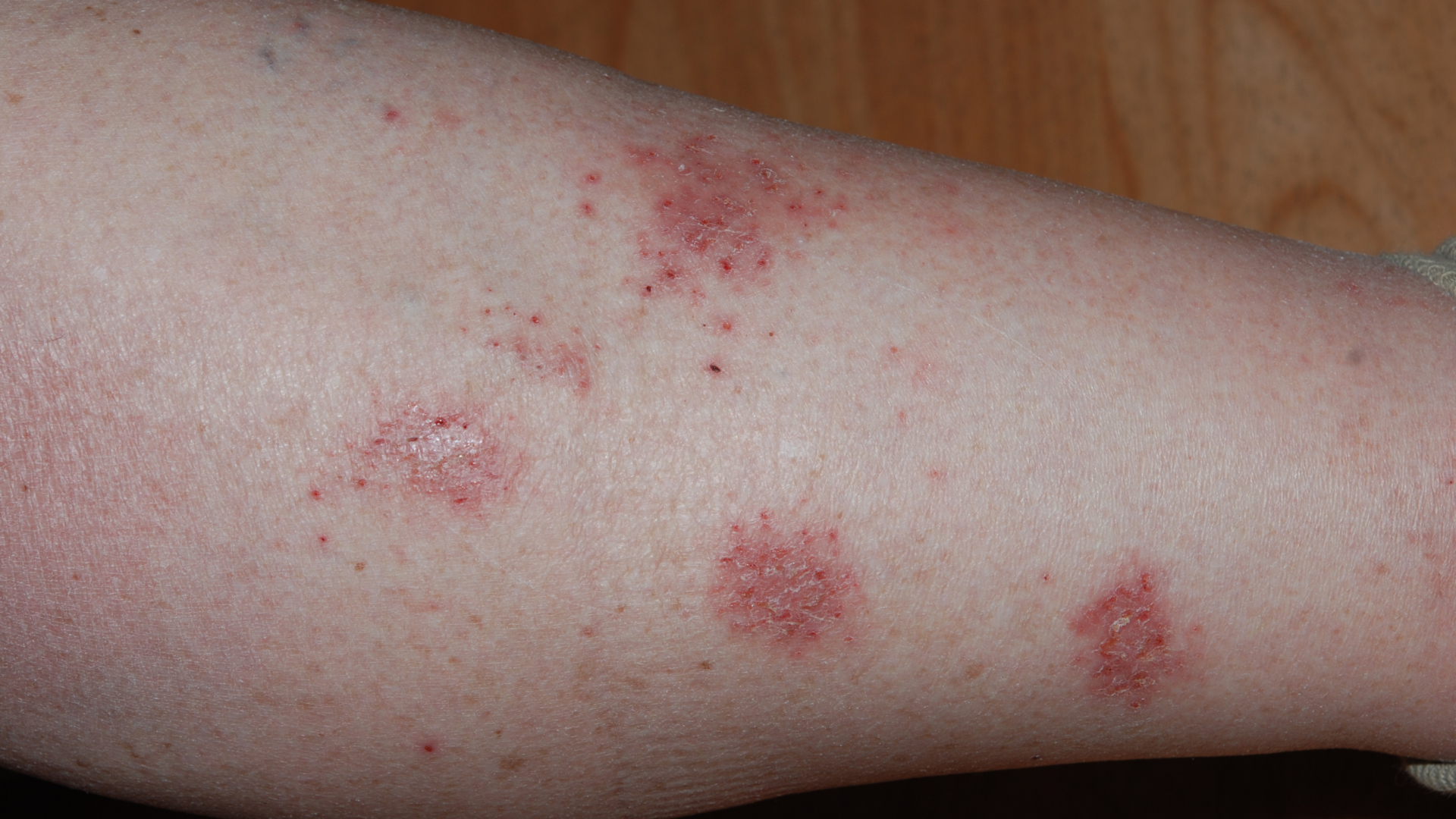 Eksem: Nummulärt eksem, mynteksem | Praktisk Medicin