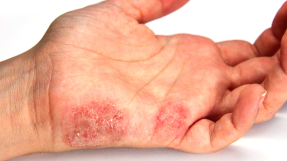 Svampinfektioner i huden: Tinea manuum, handsvamp