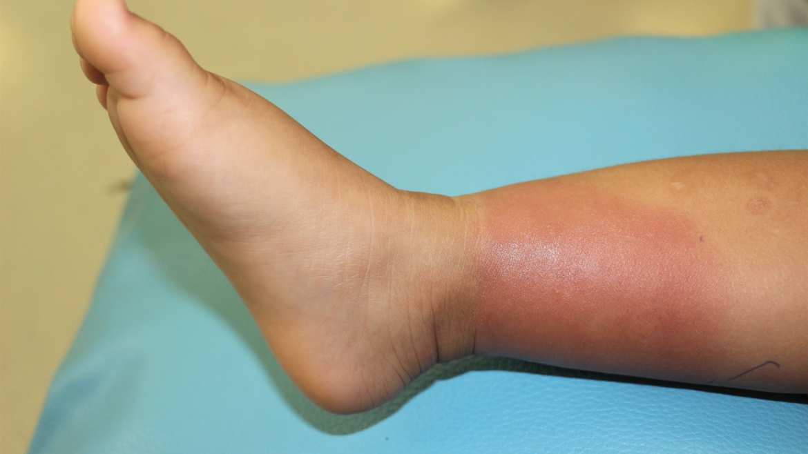 Erysipelas, rosfeber | Praktisk Medicin